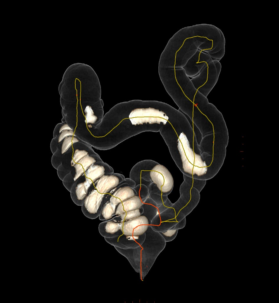 La colonscopia virtuale | Obiettivo Benessere